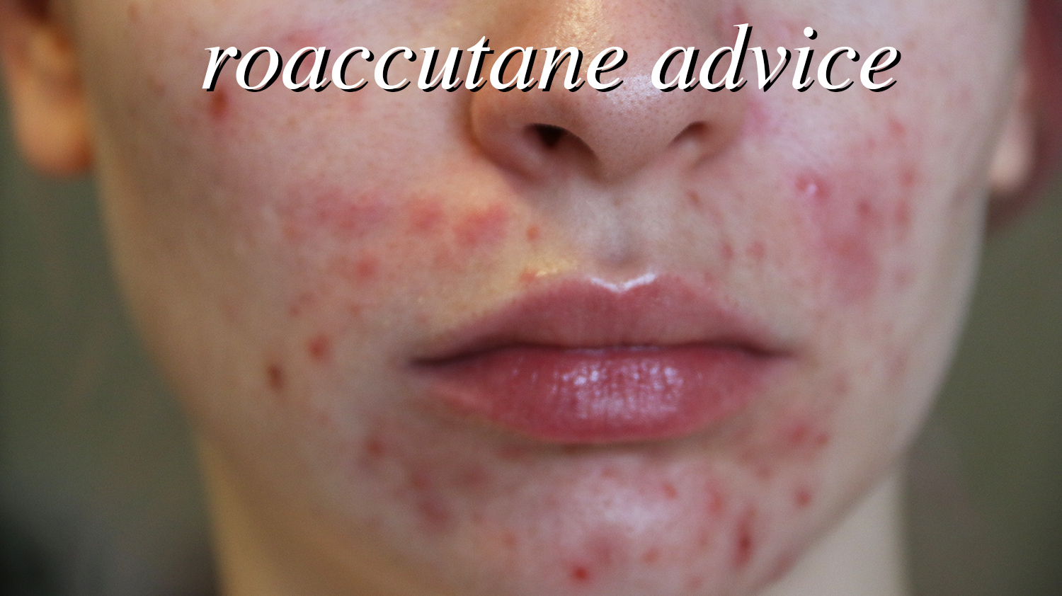 The Best Advice for Starting Roaccutane! - Katie Snooks